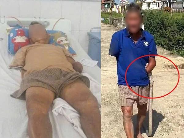 Ông lão cụt tay kẹp rắn hổ mang sau khi bị cắn ở Đà Nẵng, bệnh viện ...